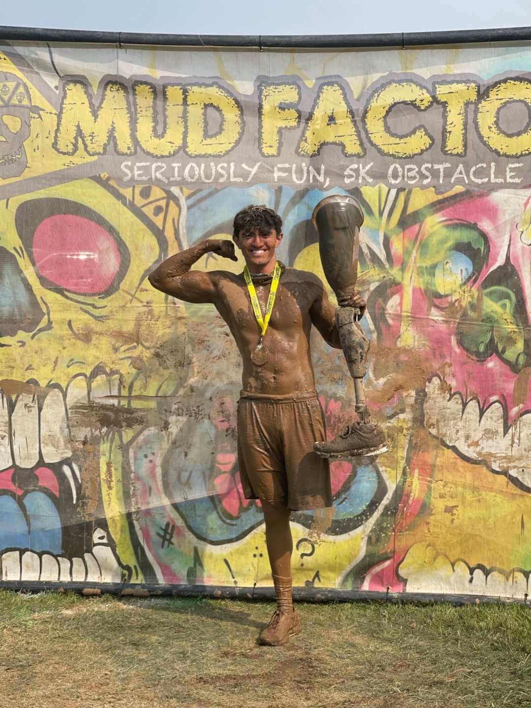 Hanger Clinic Blog | Alex Parra: Cancer Survivor Thriving with Above ...