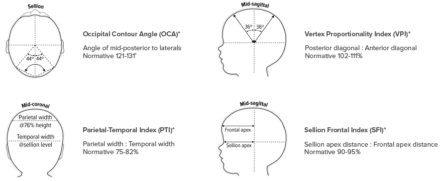 Hanger Clinic | Comprehensive Craniometry for Sagittal Synostosis