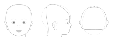 Cranial Asymmetry | Hanger Clinic