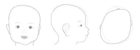 Cranial Asymmetry | Hanger Clinic