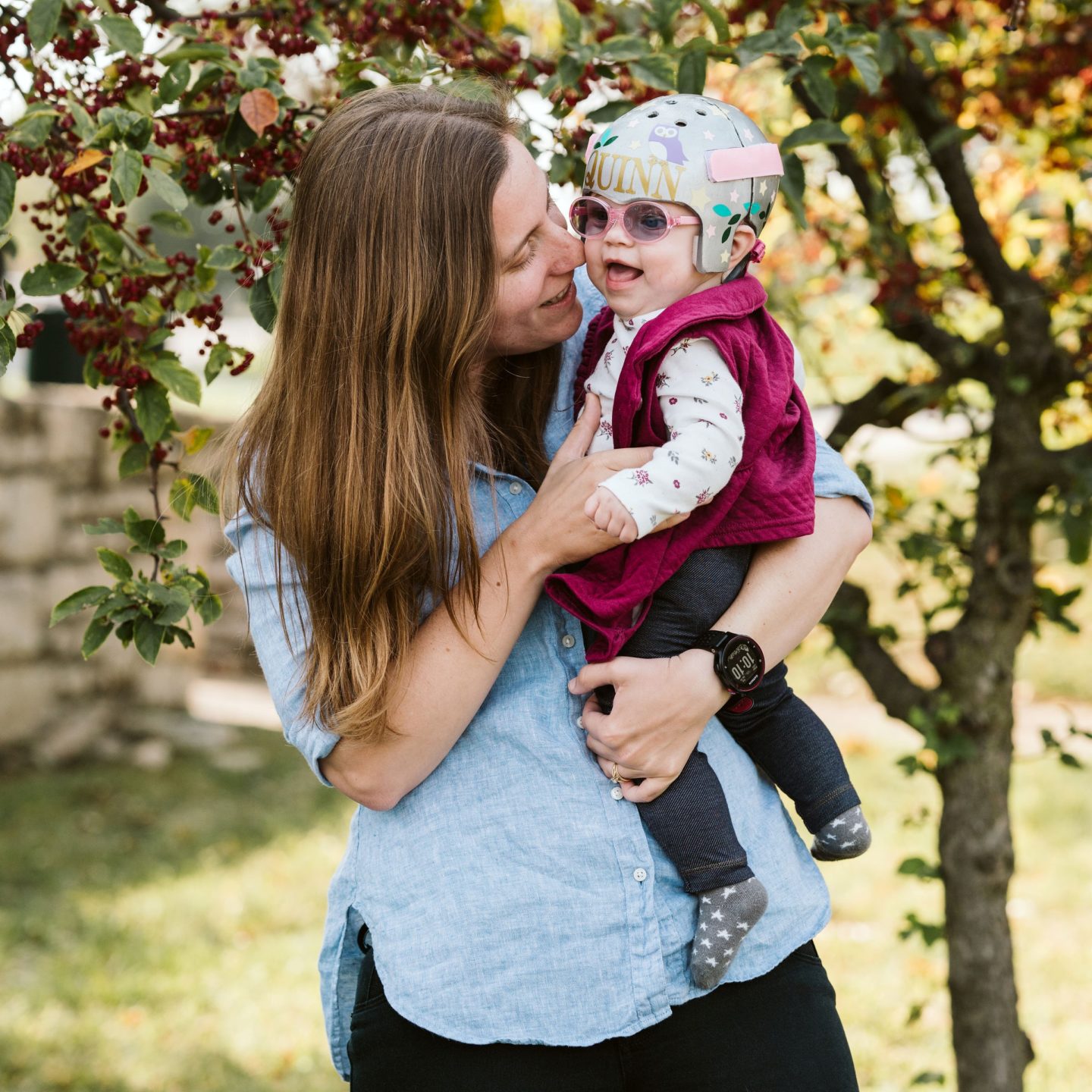 Craniosynostosis | Hanger Clinic