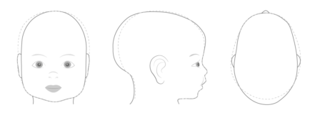 Cranial Asymmetry | Hanger Clinic